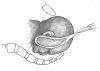 Assisted Delivery vs C Section - What's the Difference? • Kopa Birth®